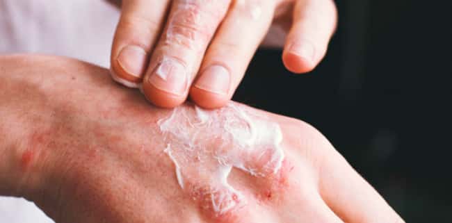 Enfermedad de la Pelagra - causas, síntomas y tratamiento | Salud Responde