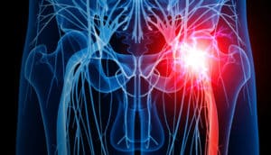 El Síndrome del Piriforme - ¿Qué es, Síntomas y Tratamiento | Salud ...